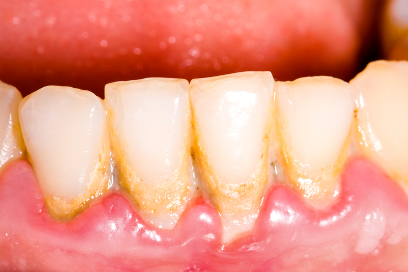 How to Remove Plaque at Home: Best Treatment Plan – supersmile